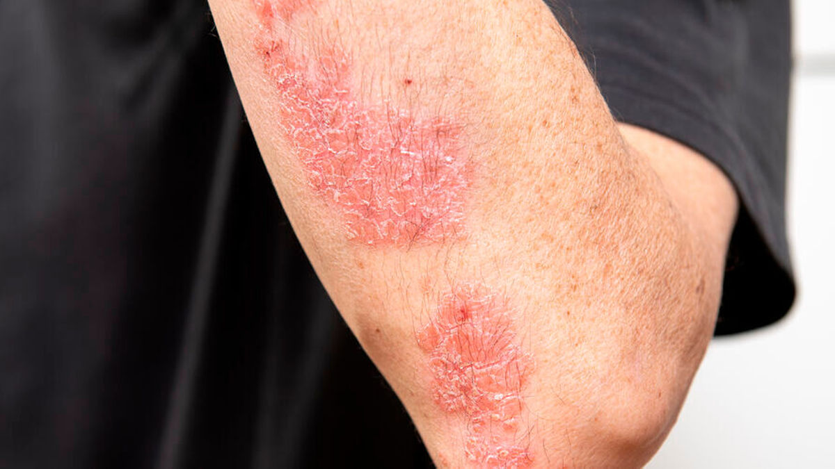 Plaque-Psoriasis: Risankizumab wirkt langfristig