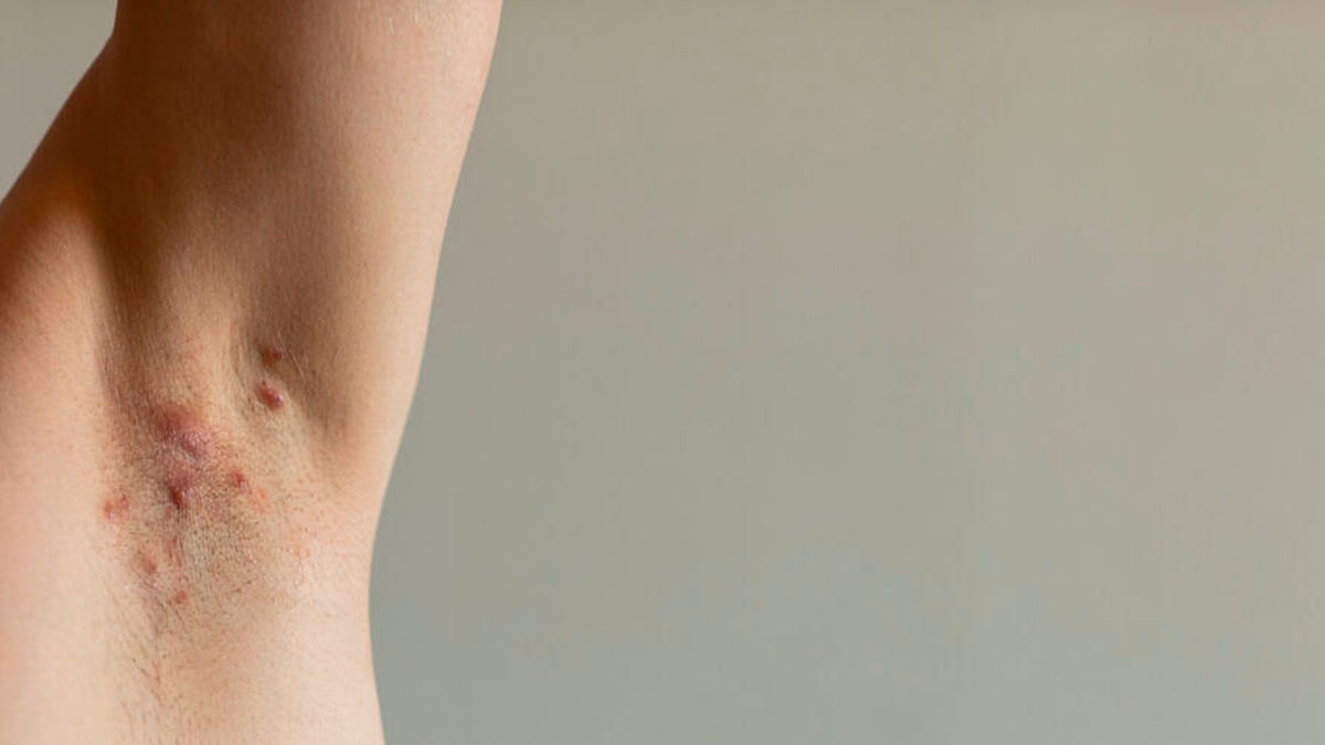 Hidradenitis suppurativa: IL-17A- und IL-17F-Inhibitor in EU zugelassen