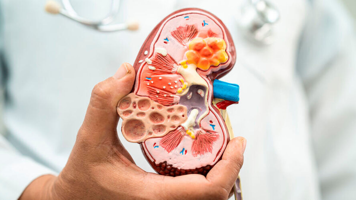 CKD mit Albuminurie und Typ-2-Diabetes: Finerenon reduziert Risiko für ...