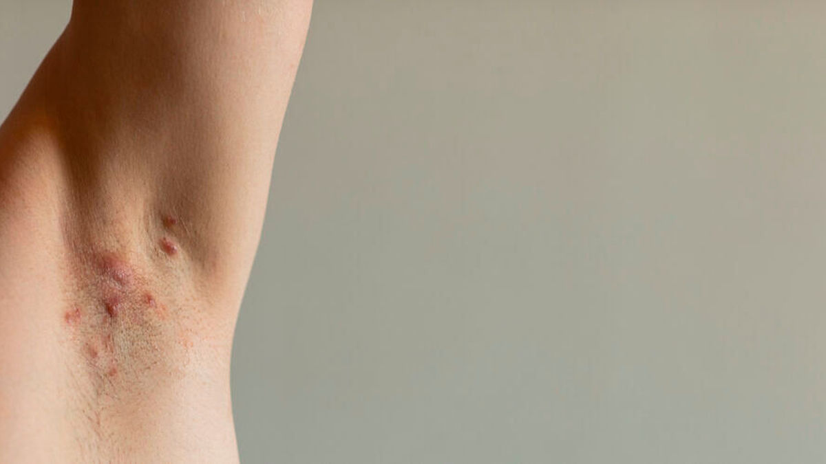 Acne inversa: Zulassungsempfehlung für Bimekizumab