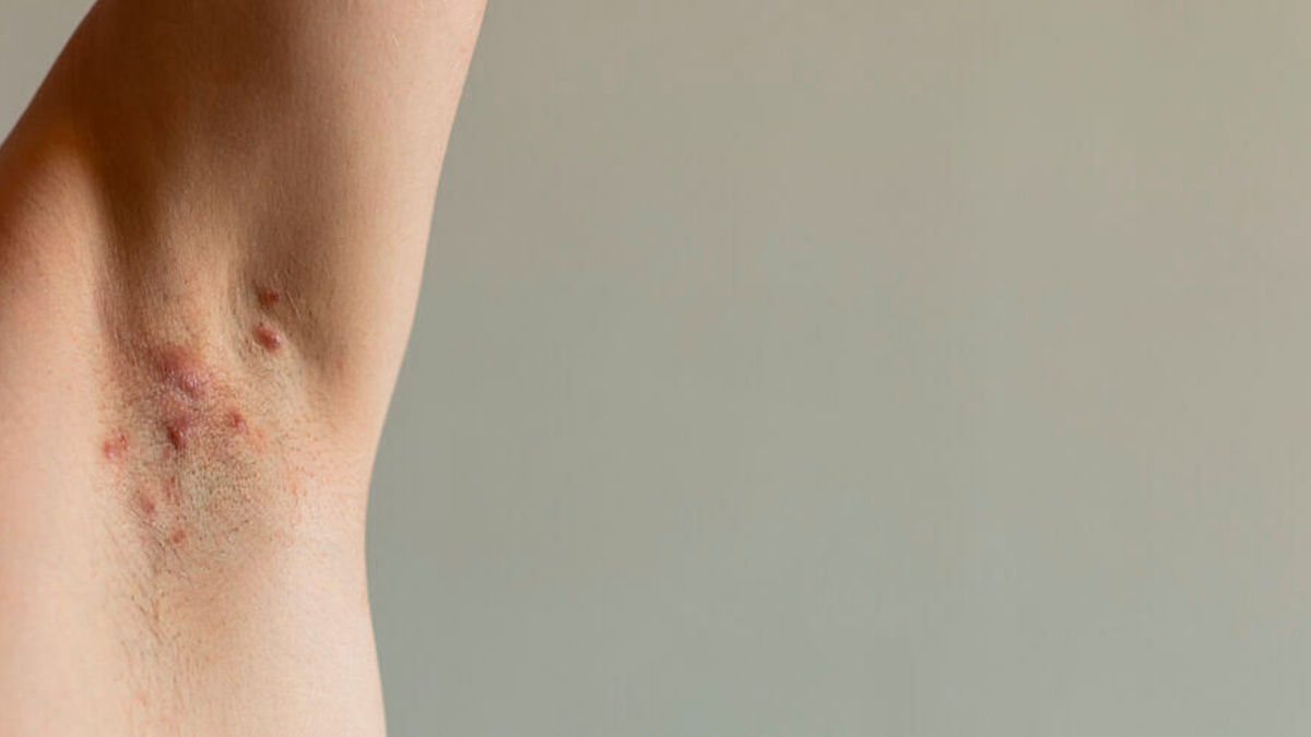 Acne inversa: Zulassung von Secukinumab