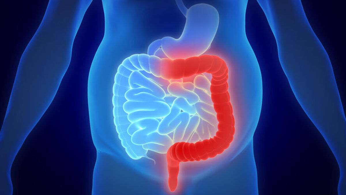 Ansprechen auf Golimumab bei Erwachsenen mit aktiver moderater bis ...