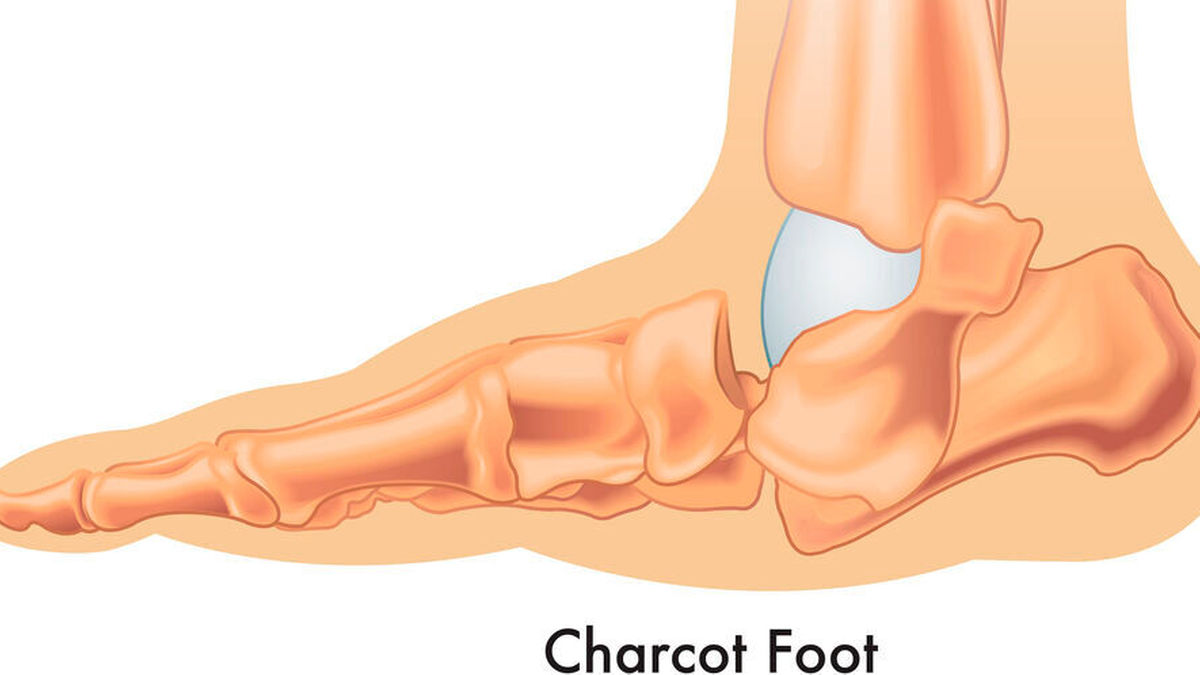 Menschen mit Diabetes: "Charcot-Fuß" erkennen und verhindern